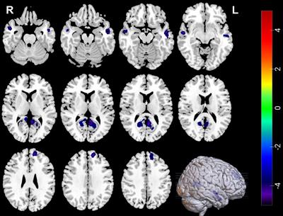 Frontiers | Changes in gray matter volume following electroconvulsive therapy in adolescent ...